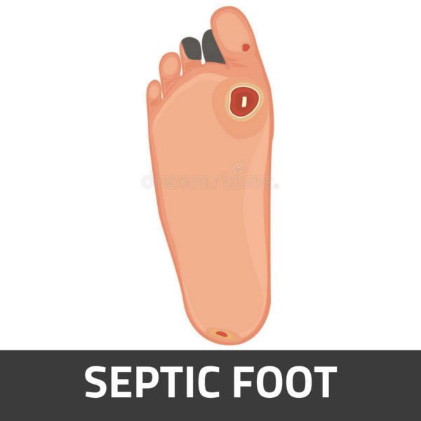 Diabetic Foot Conditions – Caribbean Orthopaedic Foot and Ankle Institute